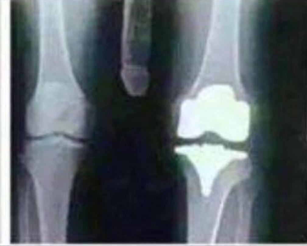 Fell off my bike, shattered knee cap. X rays. | DIYnot Forums